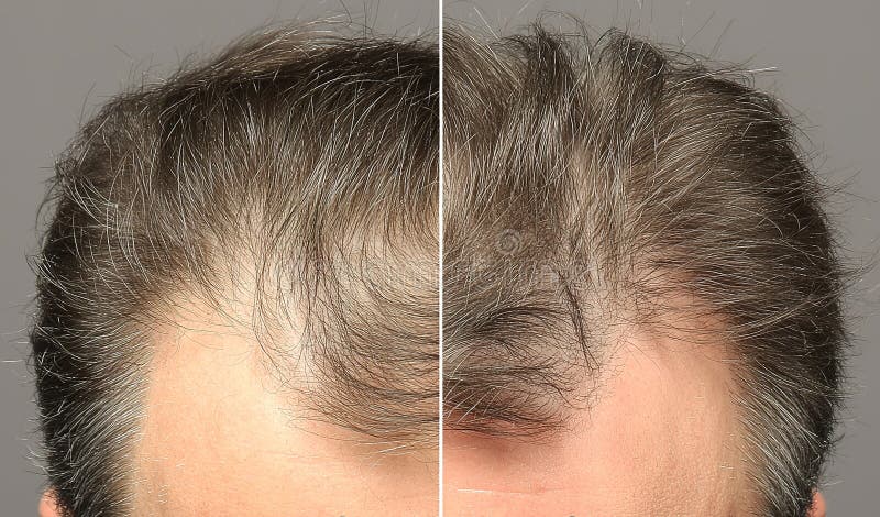 A Striking Transformation Showcasing the Effectiveness of Hair ...