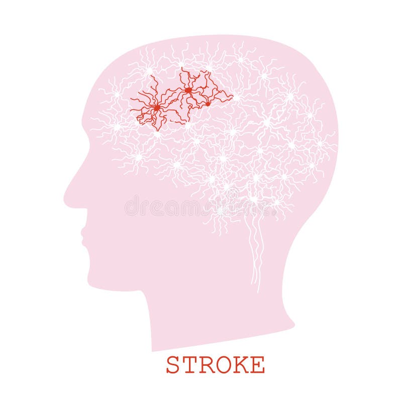 Stroke Concept with Human Head Silhouette Stock Vector - Illustration ...
