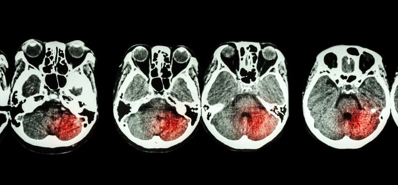 Stroke ( CT Scan of Brain and Base of Skull and Stroke ) Stock Image ... Stroke ( CT Scan of Brain and Base of Skull and Stroke ) Stock Image ...