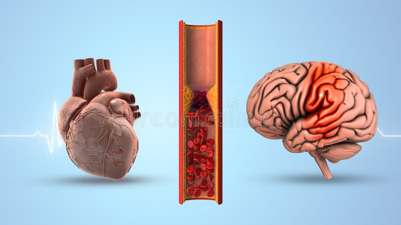 Brain Stroke and Heart Attack Stock Photo - Image of stress, human ...