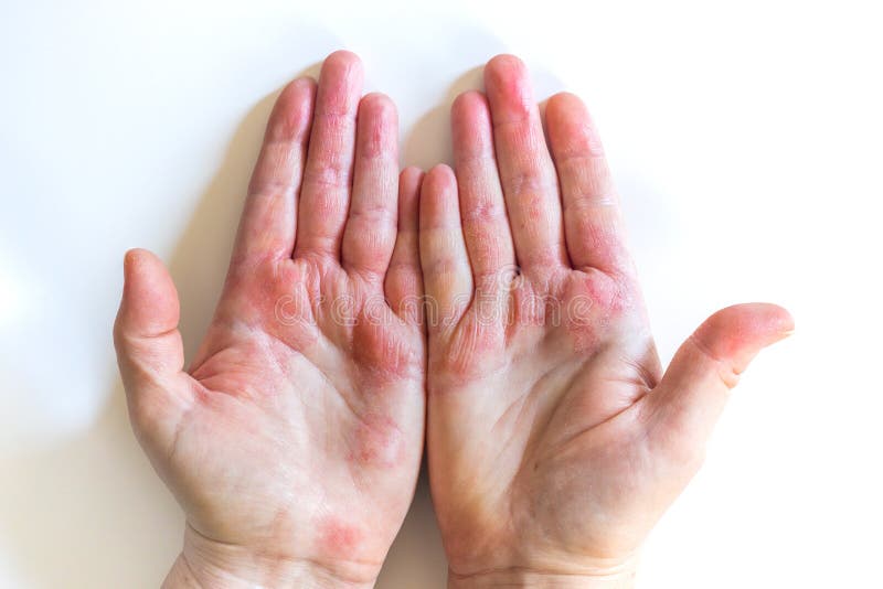 Atopic Dermatitis, Red, Itchy Hands with Blisters and Chapped Skin ...