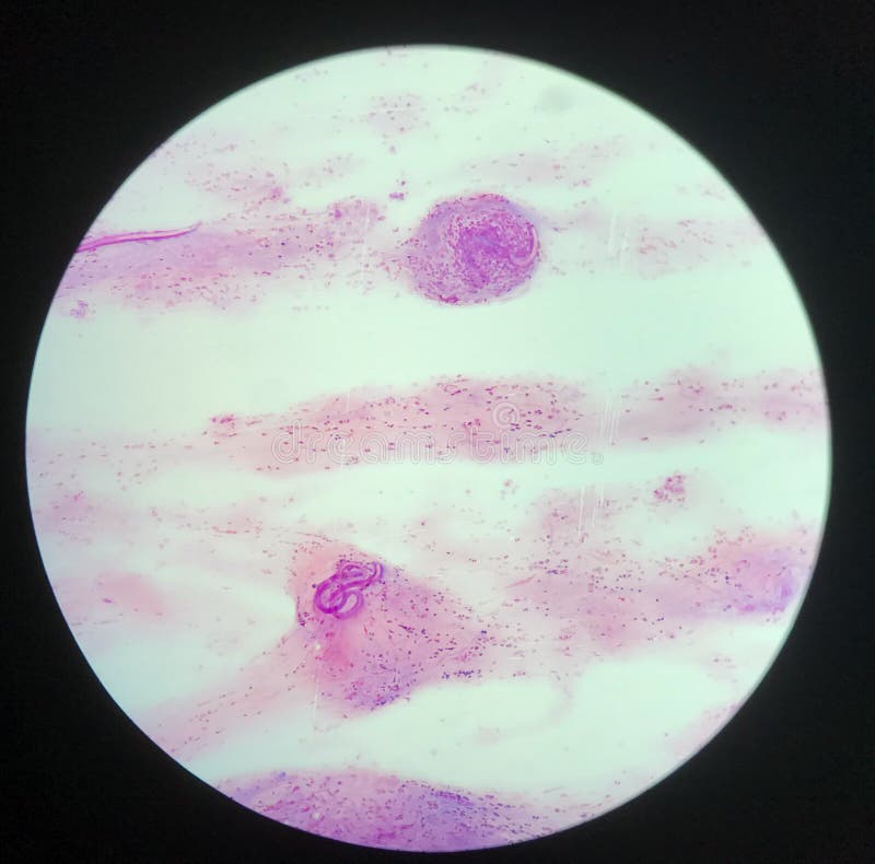 Strongyloides Stercoralis Parasit in Human Stock Photo - Image of ...