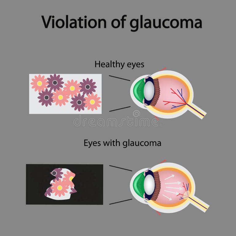 Blurred Vision Stock Illustrations – 10,967 Blurred Vision Stock ...