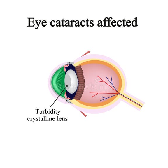 The Structure of the Eye. Eye Cataracts Affected Stock Vector ...