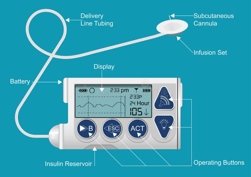 Medical Infusion Pump Stock Illustrations – 456 Medical Infusion Pump ...