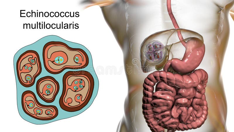 Hydatid Cyst of Echinococcus Multilocularis Stock Illustration ...