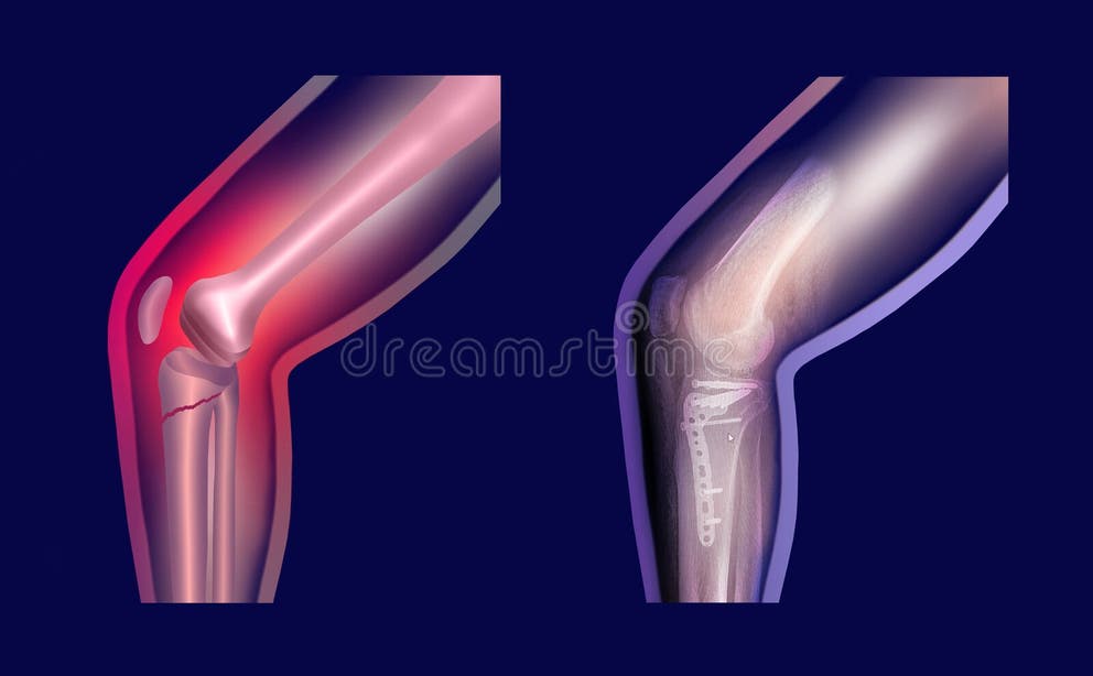 Structure of Knee and Rx-ray Image of Knee, Tibia Fracture with Post ...