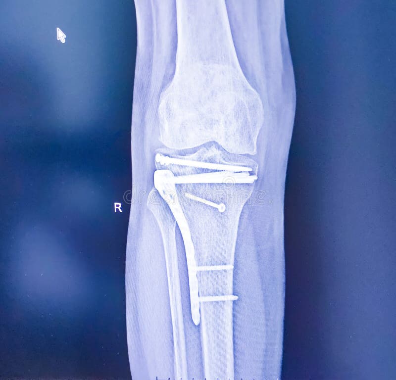 Structure of Knee and Rx-ray Image of Knee, Tibia Fracture with Post ...