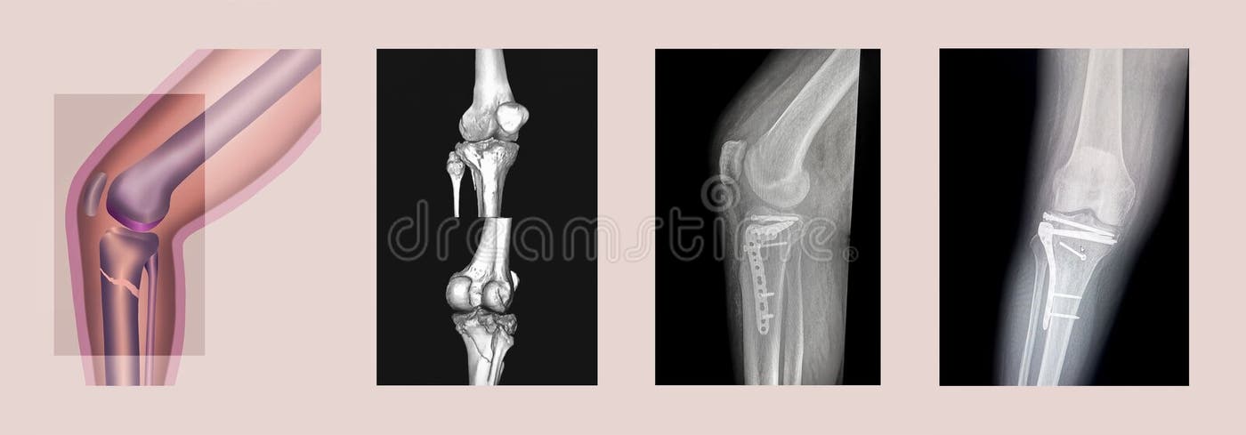 Fixation Tibia Stock Illustrations – 4 Fixation Tibia Stock ...