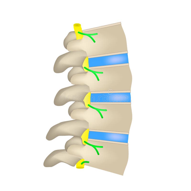 Intervertebral Disc Damage. Vertebra Stock Vector - Illustration of ...