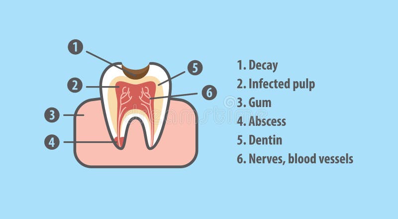 Decay and Abscess Cross-section Structure Inside Tooth Stock Vector ...