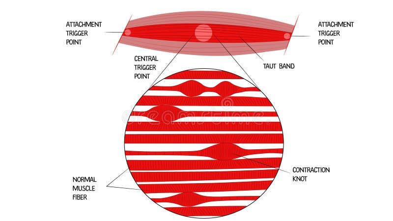 The Structure of the Trigger Point in the Muscle. Attachment Trigger ...