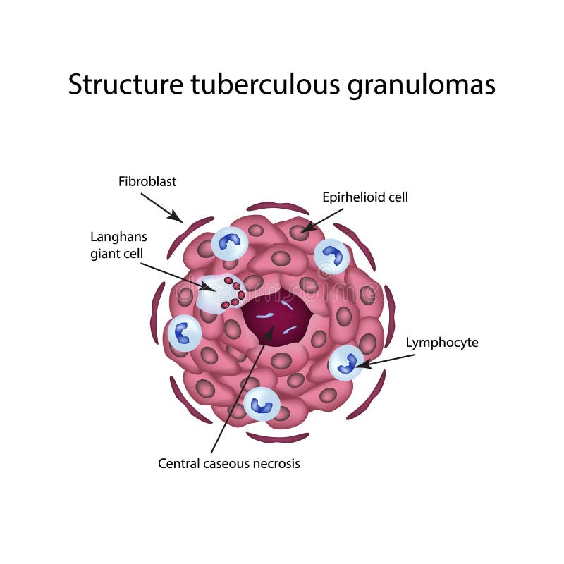 The Structure of Tuberculous Granulomas. Vector Illustration on ...