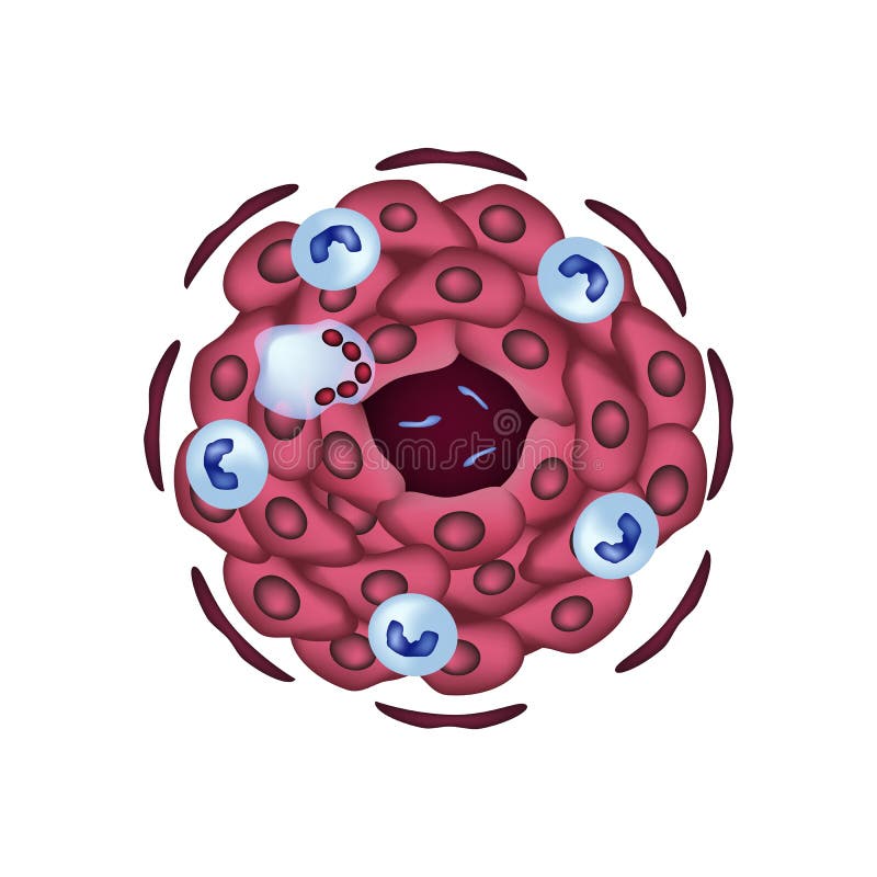 The Structure of Tuberculous Granulomas. Vector Illustration on ...