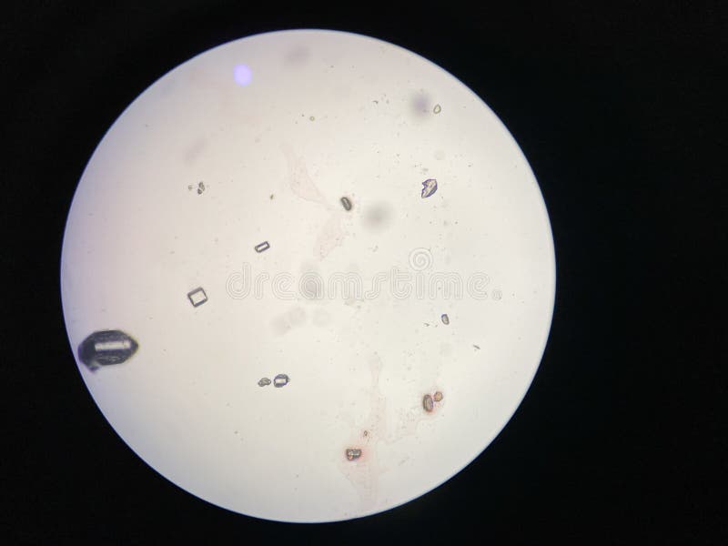 Struvite Crystals Stock Photos - Free & Royalty-Free Stock Photos from ...