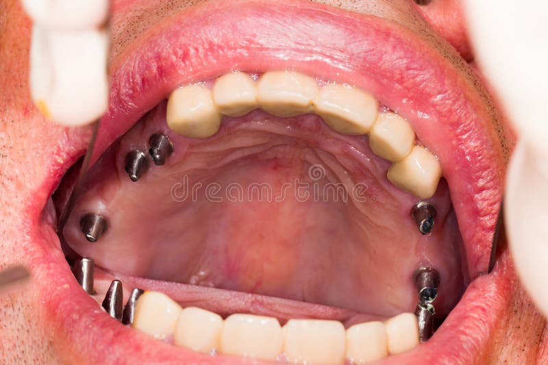 Dental Stub for Crown with Retraction Thread Stock Photo - Image of ...