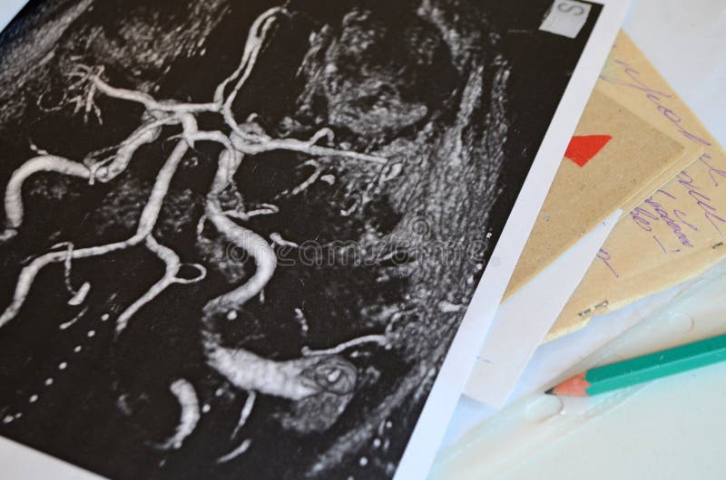 Study of the Brain after a Stroke - Neuron Stock Photo - Image of ...