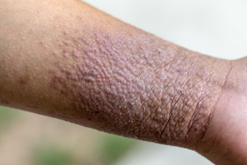 Study of Physical of Atopic Dermatitis AD, Also Known As Atopic Eczema ...