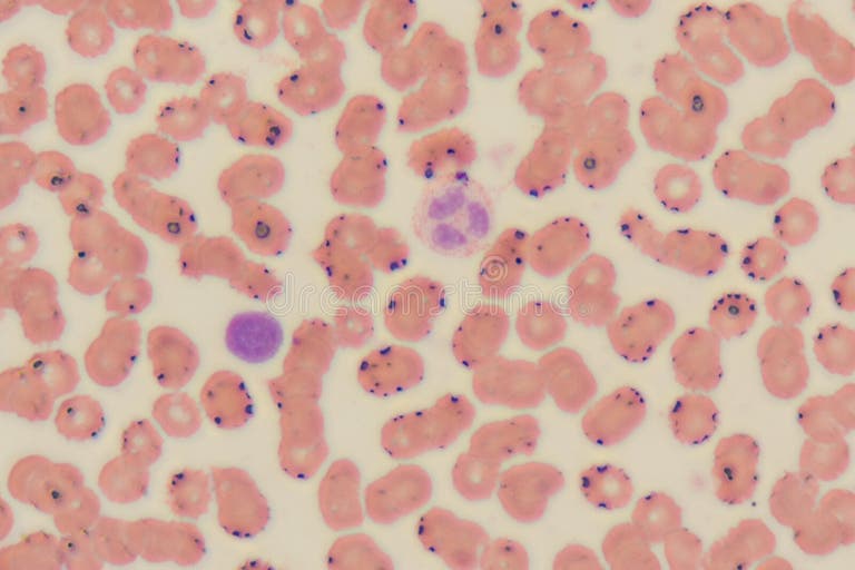 215 Abnormal Red Blood Cells Science Background Stock Photos - Free ...