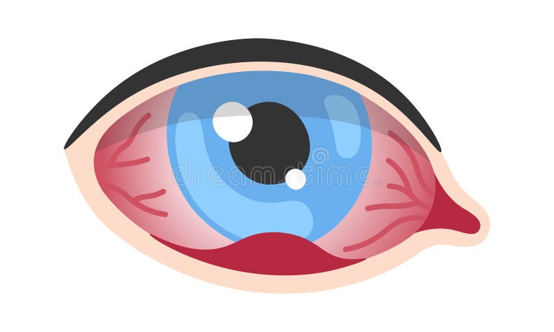 Stye Human Eye Disease stock illustration. Illustration of stye - 276072242