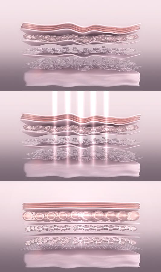 Skin before and after Laser Collagen-boosting Therapy Stock ...