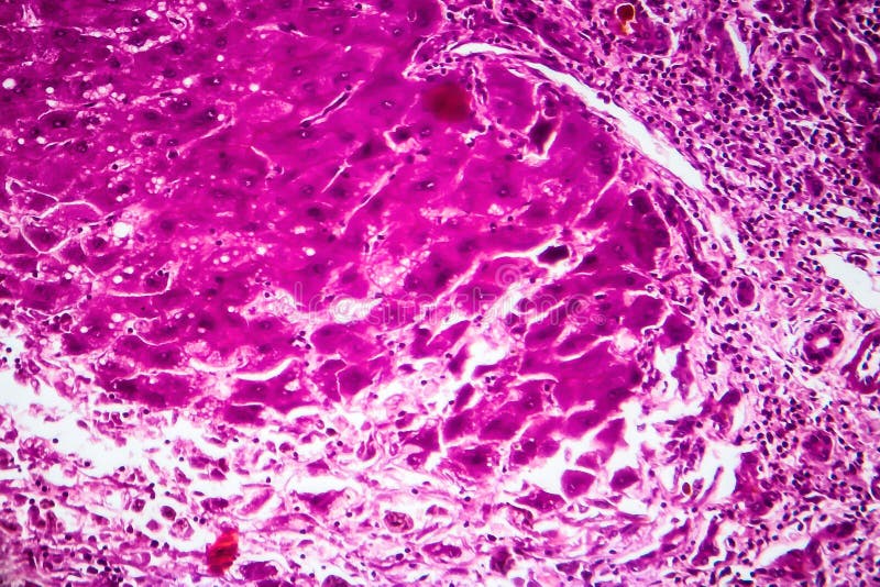 Subacute Severe Hepatitis, Light Micrograph Stock Illustration ...