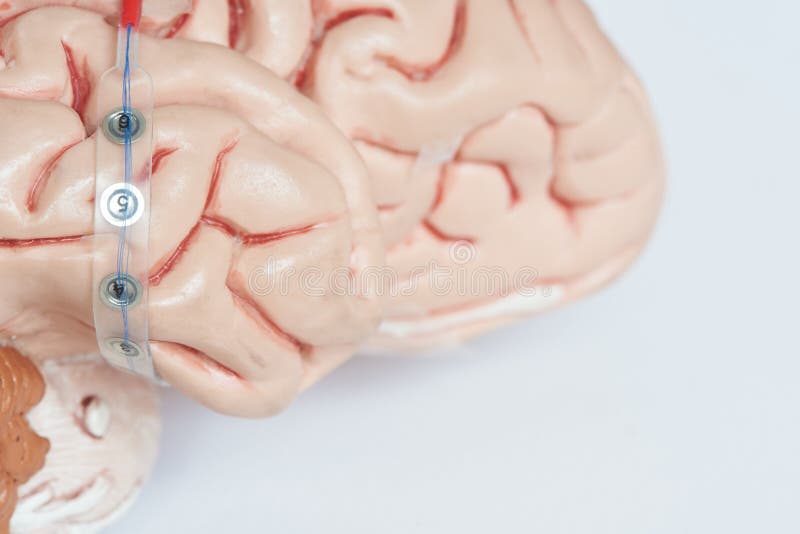 Subdural Grid Electrode for Brain Waves Recording on the Brain Model ...