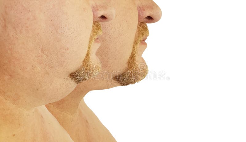 Submental Stock Photos - Free & Royalty-Free Stock Photos from Dreamstime