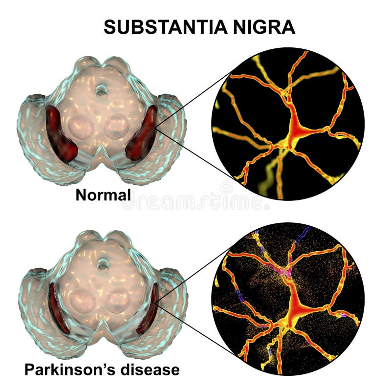 Substantia Nigra in Norm and in Parkinson`s Disease Stock Image - Image ...