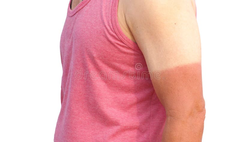 Sunburn stock image. Image of lines, roasted, medical, clipping - 818347