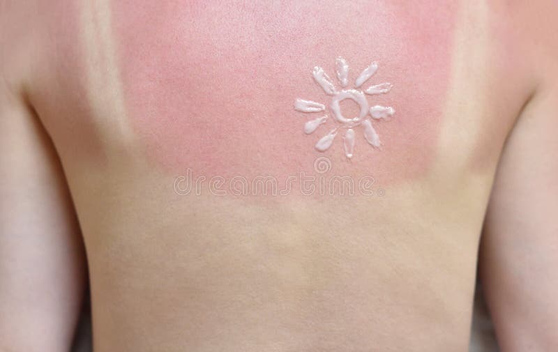 Sunburn and Red Skin on a Female Back with a Painted Sun from a ...