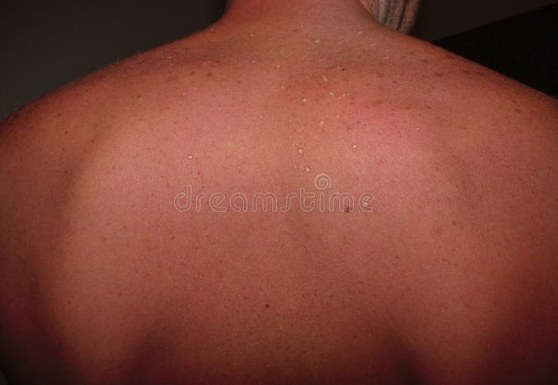 Sunburn on back stock image. Image of person, burn, damage - 256466743