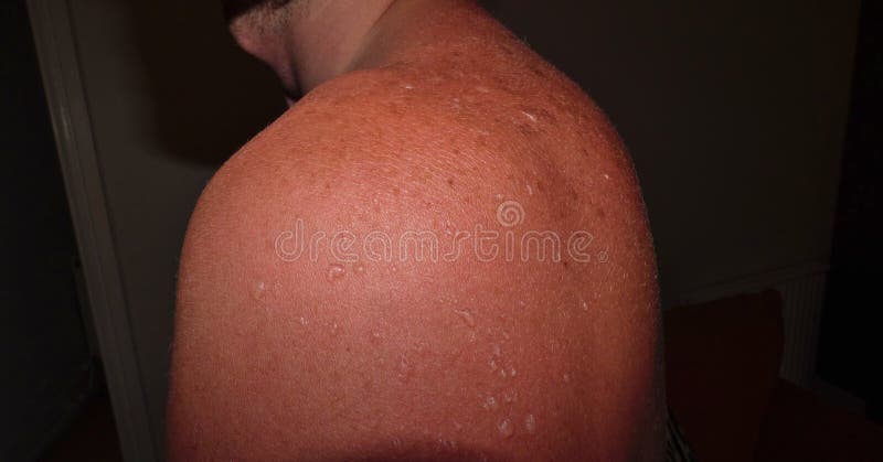 Sunburn on Side Arm Shoulders Stock Photo - Image of shoulders ...