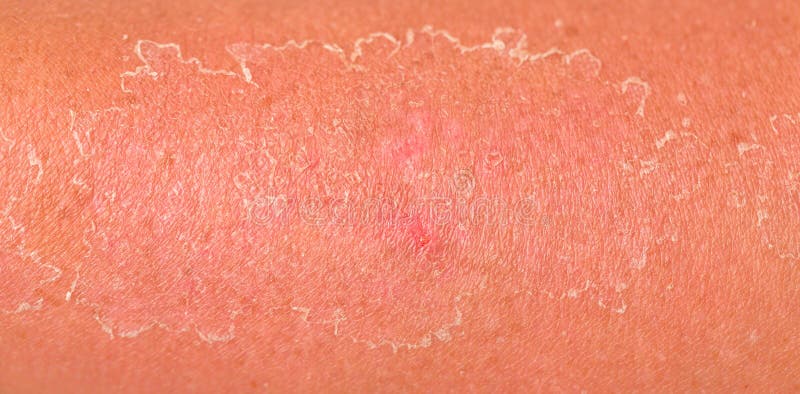 Sunburn Skin As a Texture or Background. Selective Focus Stock Image ...