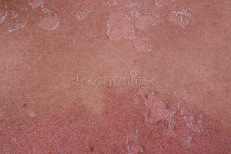 Sunburn skin stock photo. Image of cancer, protect, pattern - 57451918