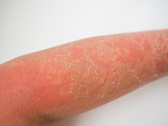 Sunburn on the skin stock image. Image of solarium, dermatology - 221055417