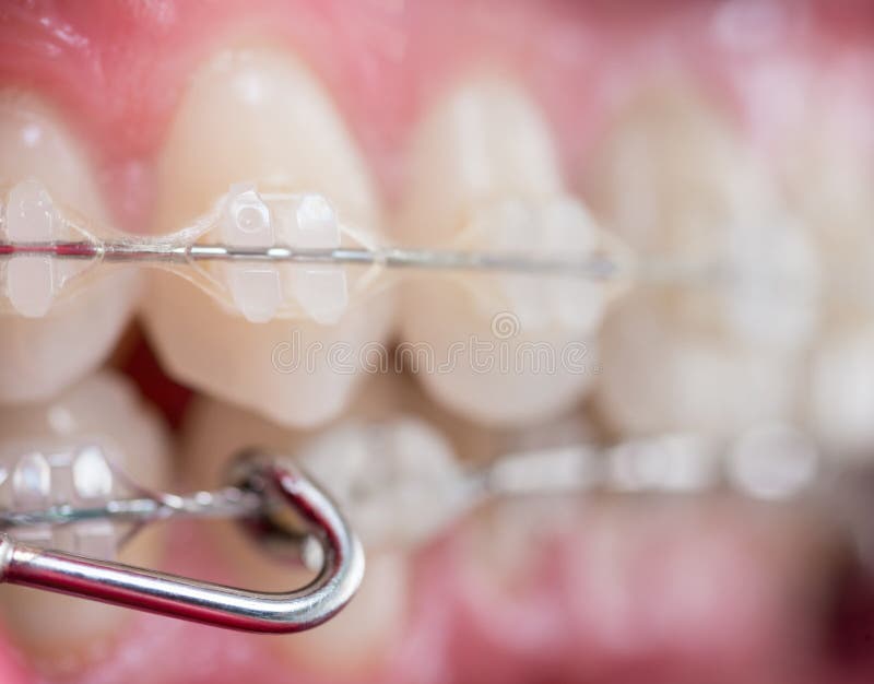 Shot of X Ray of Teeth Isolated on White Background Stock Photo - Image ...