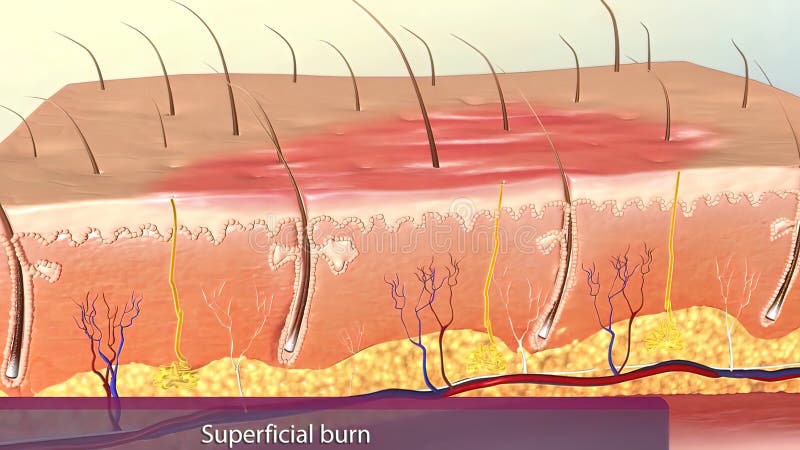 Superfucial Partial, Thickness Burn Stock Illustration - Illustration ...