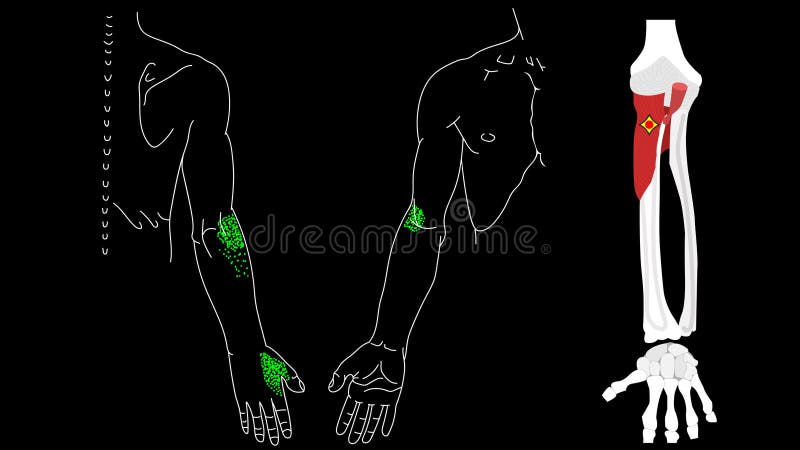 Supinator Muscle. Trigger Points in the Muscles of the Hands Stock ...