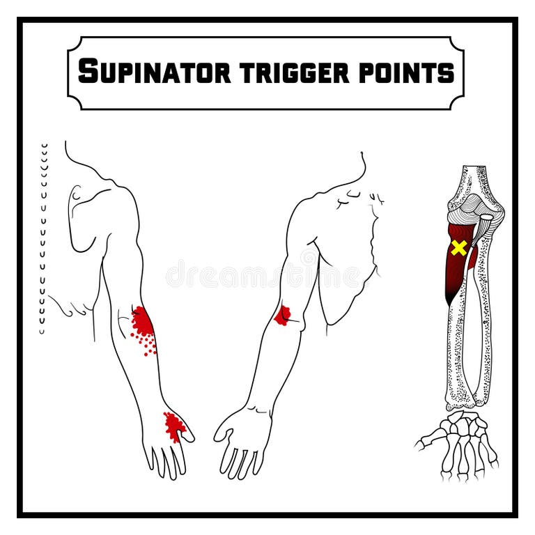 Supinator Trigger Points Vector Diagram Editable Stock Vector ...