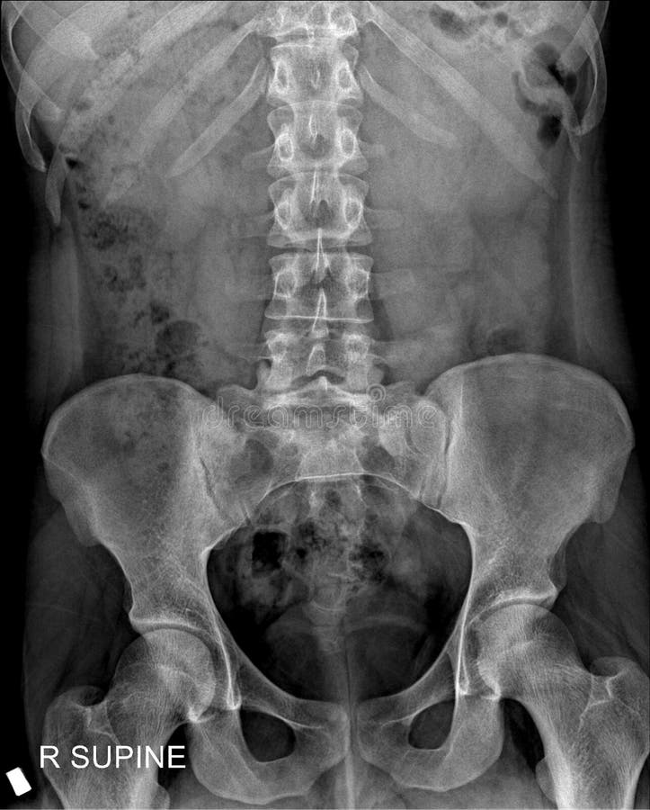 Abdominal X-ray for Diagnostic Imaging Stock Photo - Image of exam ...