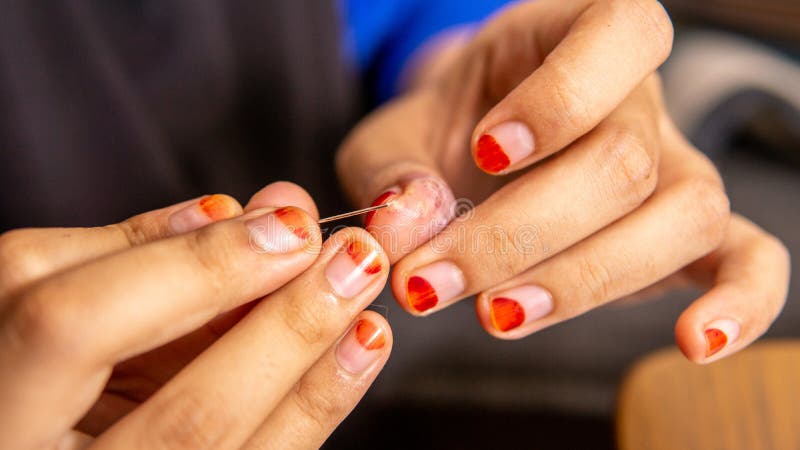 Suppression Du Pus Dans L'infection De La Plaie Du Pouce Image stock ...