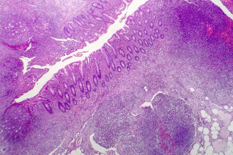 Suppurative Appendicit, Ljus Micrograph Fotografering för Bildbyråer ...