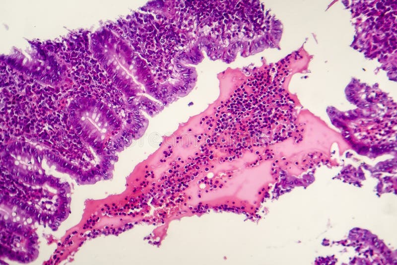 Suppurative Appendicitis, Light Micrograph Stock Photo - Image of ...