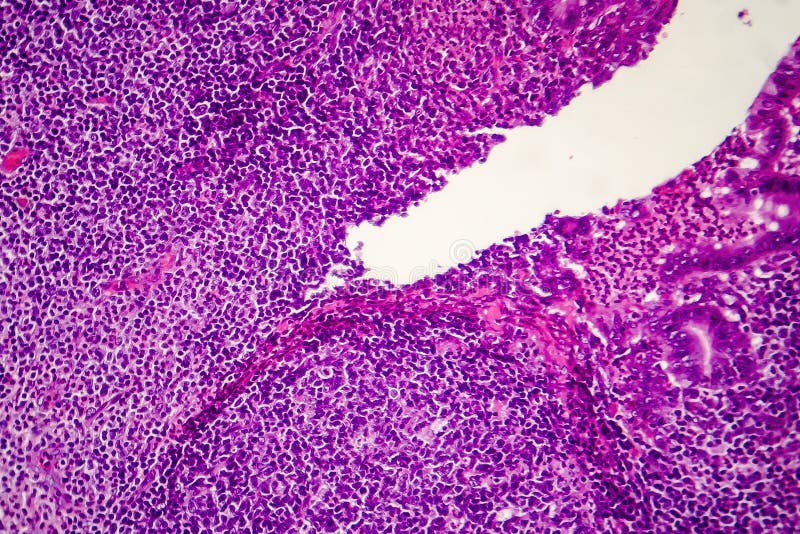 Suppurative Appendicitis, Light Micrograph Stock Image - Image of ...