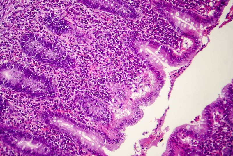 Suppurative Appendicitis, Light Micrograph Stock Photo - Image of ...