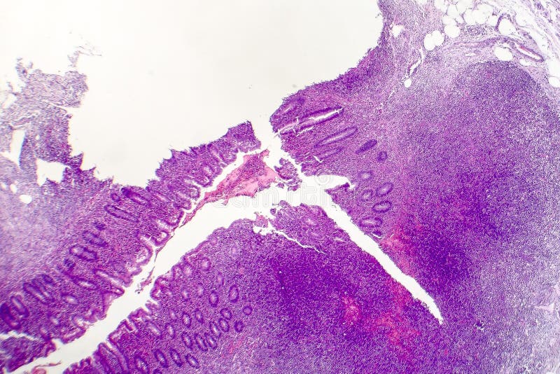 Suppurative Appendicitis, Light Micrograph Stock Photo - Image of ...