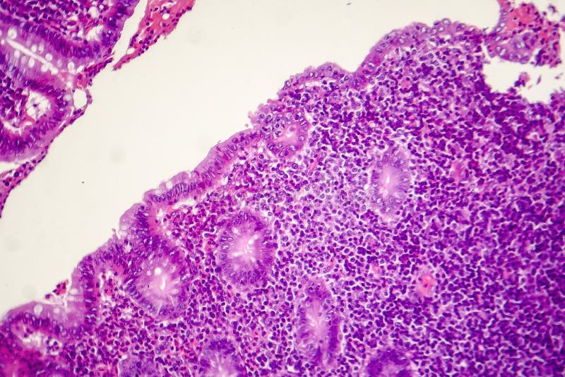 Suppurative Appendicitis, Light Micrograph Stock Image - Image of ...