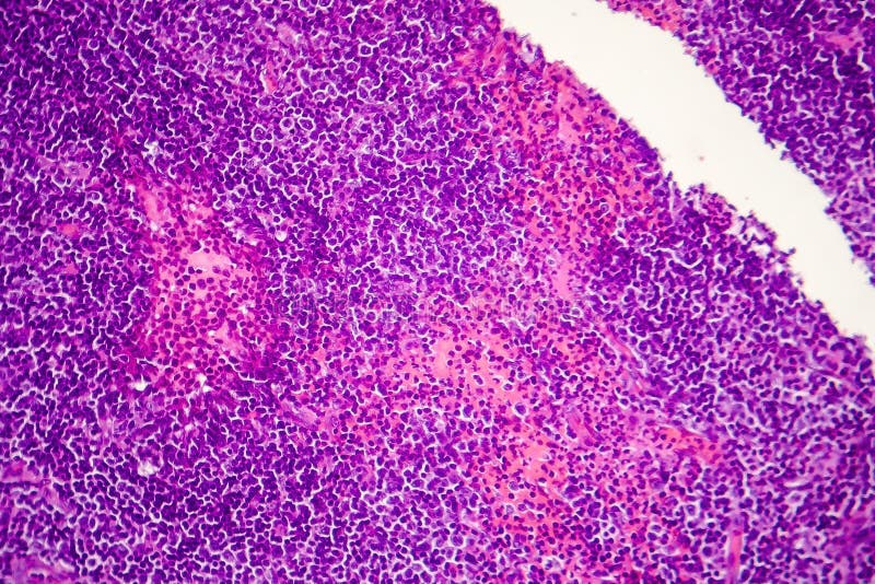 Suppurative Appendicitis, Light Micrograph Stock Photo - Image of eosin ...