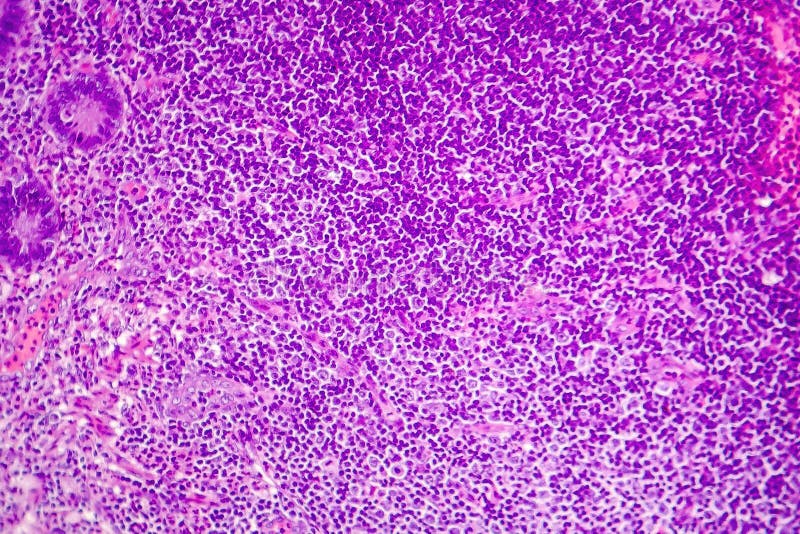 Suppurative Appendicitis, Light Micrograph Stock Photo - Image of ...